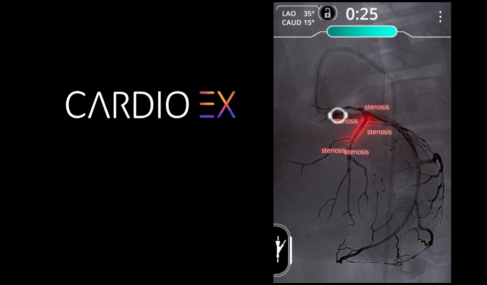 Cardio Ex: Unblocking arteries shouldn't be this fun - FantAstrial